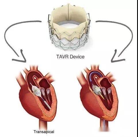 【科普】你想了解的心脏微创手术，全都在这里 - 知乎