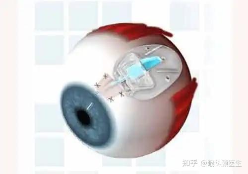 了解Ahmed青光眼阀植入术 - 知乎