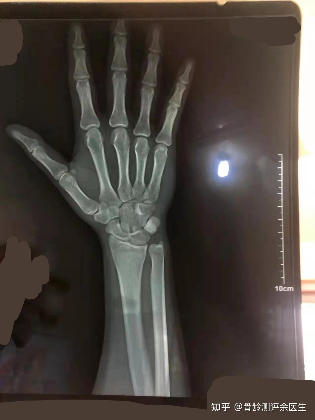 成年男孩身高和遗传相差13cm！ - 知乎