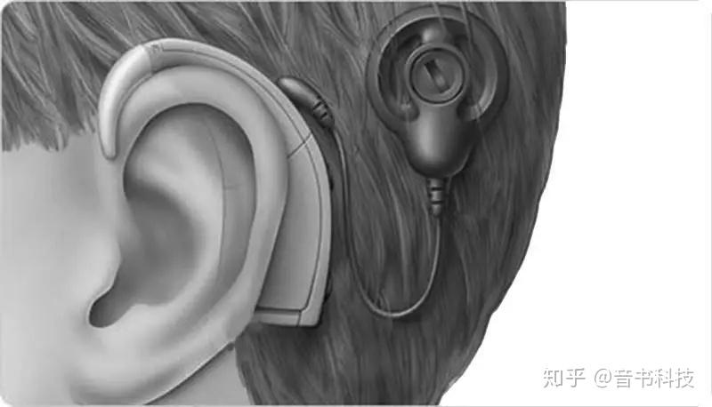 音书科普 | “小众”市场——骨导助听 - 知乎