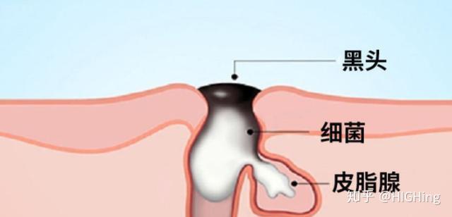 鼻子的黑头怎么天然的去掉?这些方法简单不花钱 知乎