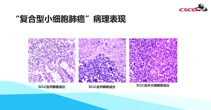 2021CSCO指南会丨复合型SCLC和转化性SCLC部分解读 - 知乎