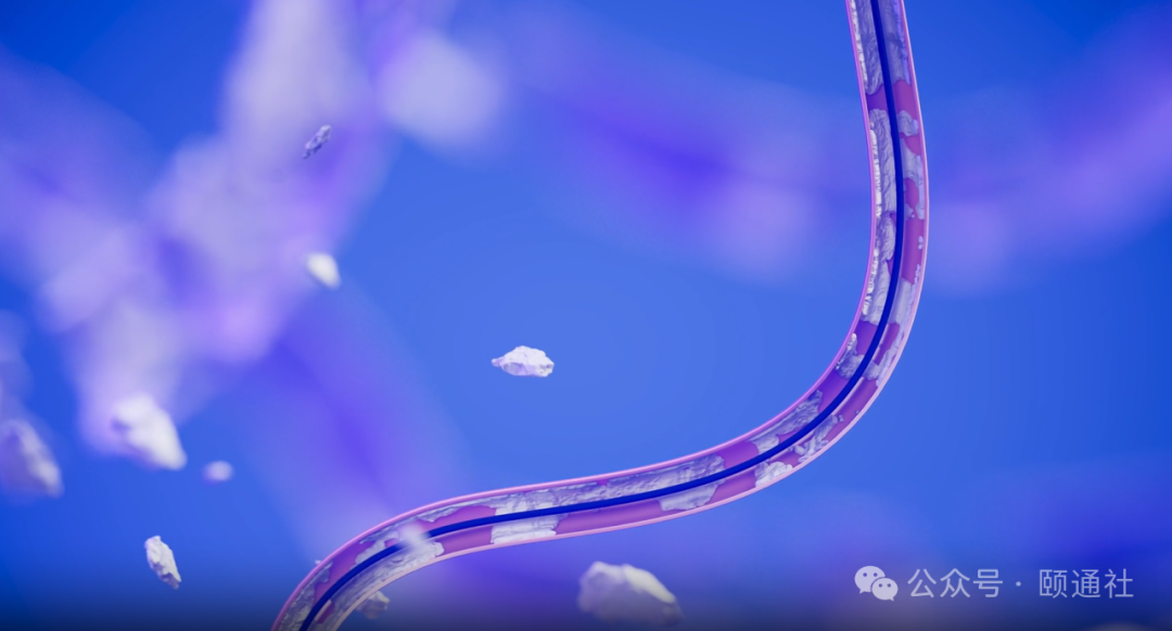 激光IVL系统首例人体应用：360°能量输出，破解血管钙化禁区难题 - 知乎