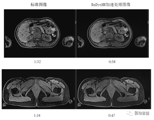 医学成像领域的奠基者系列（一）——Peter Mansfield和EPI技术 - 知乎