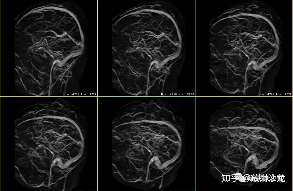 扫盲：头颅MRI该如何扫描！ - 知乎