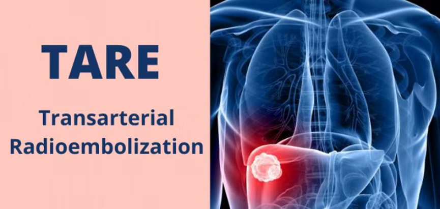 通俗讲解针对原发性肝癌和肝转移癌的高端治疗-钇90放射栓塞术 - 知乎