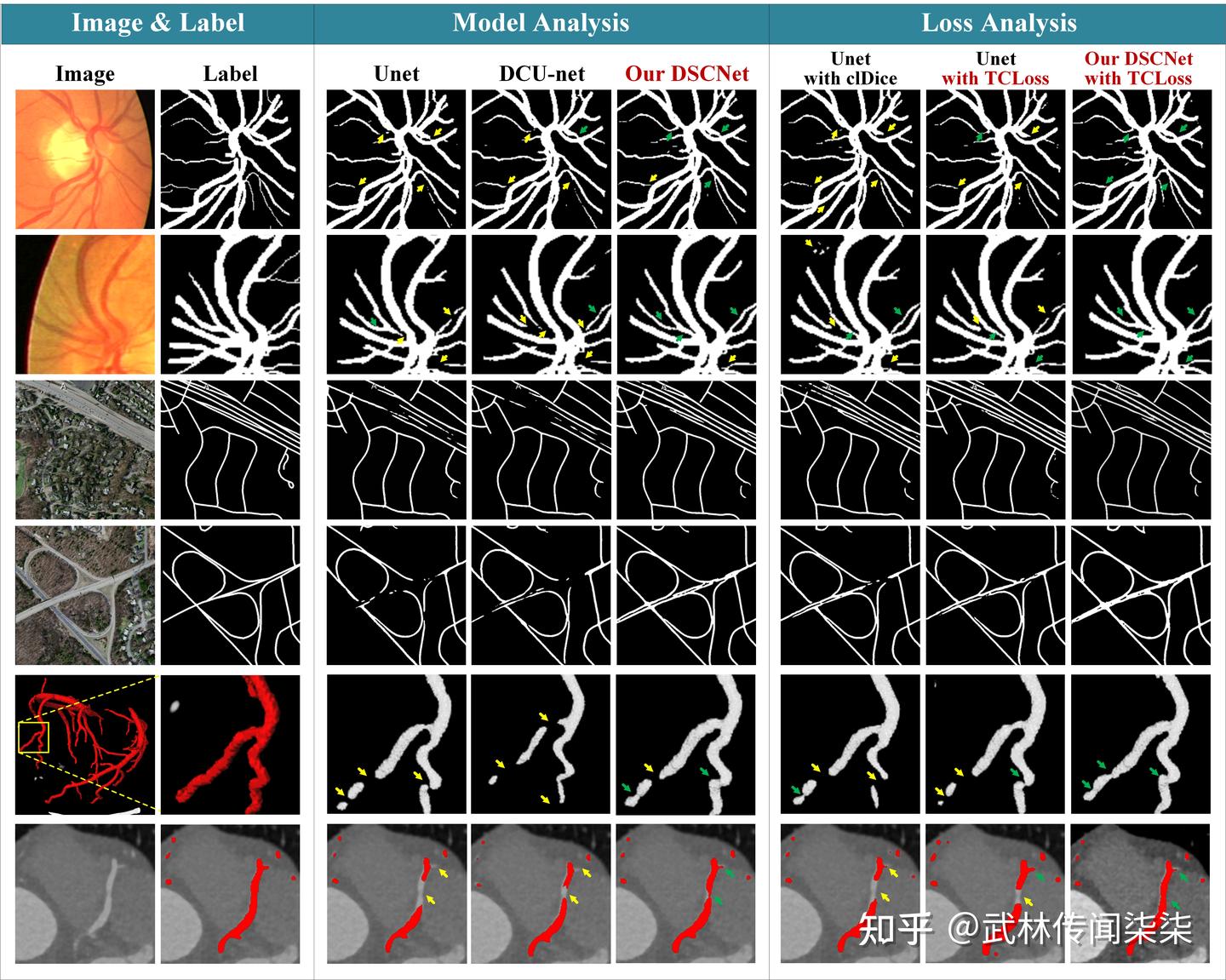ICCV2023｜动态蛇形卷积（Dynamic Snake Convolution）用于管状结构分割 - 知乎