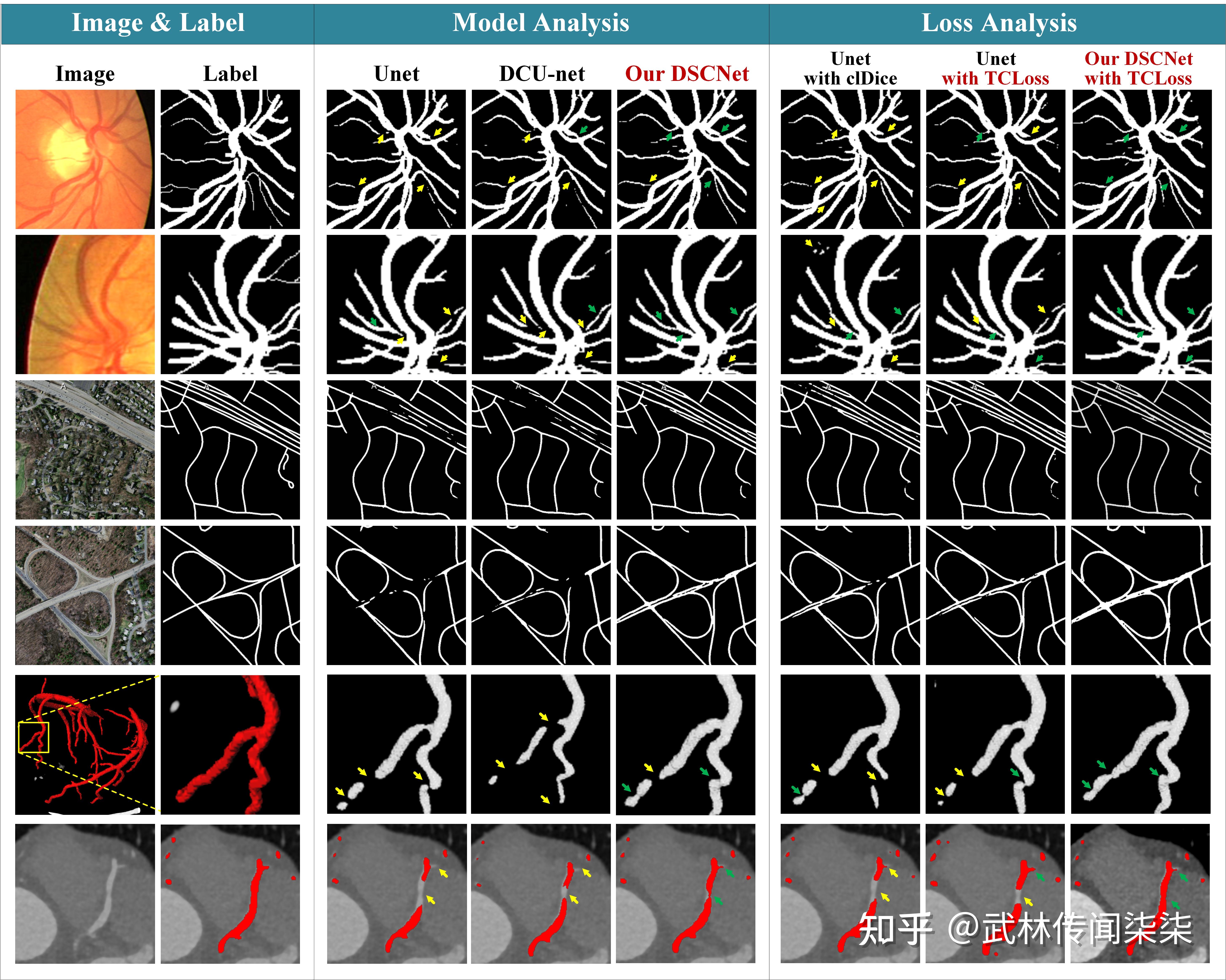 ICCV2023｜动态蛇形卷积（Dynamic Snake Convolution）用于管状结构分割 - 知乎