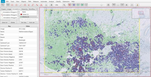 [数字病理]使用QuPath检测IHC阳性肿瘤细胞百分比 - 知乎