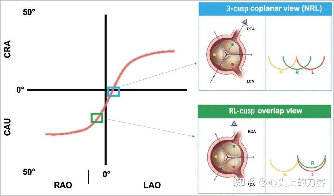 TAVR患者的冠状动脉疾病管理（三）之瓣膜植入后的冠脉通路 - 知乎