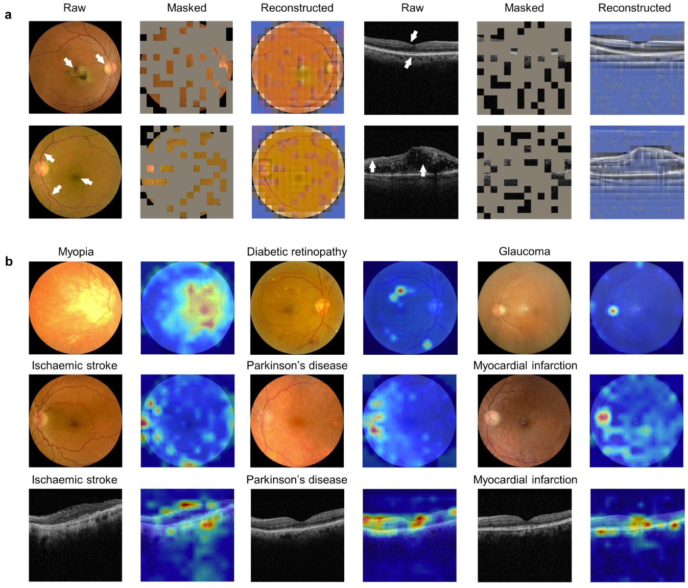 Nature 正刊｜RETFound 视网膜基础模型论文分享 - 知乎