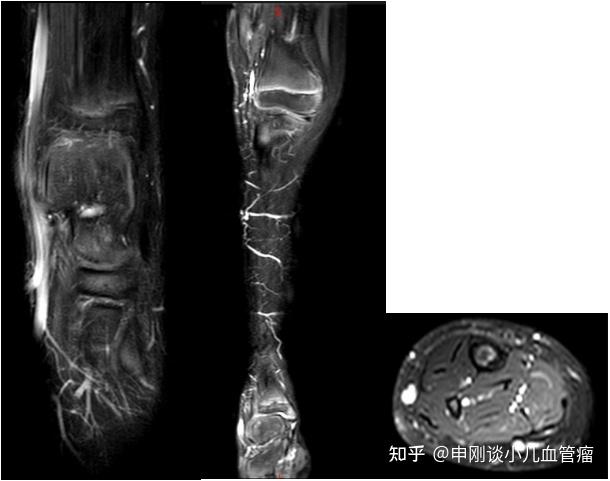KT综合征(Klippel-Trenaunay syndrome，KTS) 介入治疗 - 知乎