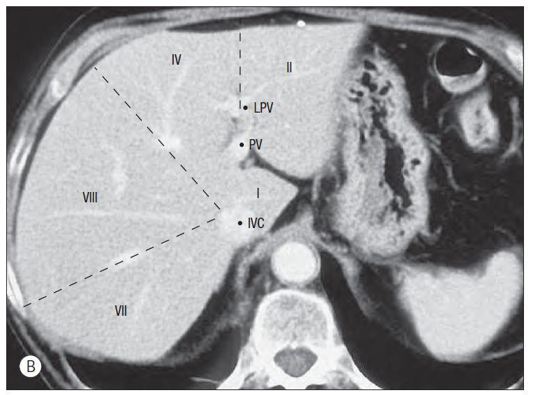 肝脏的分叶与分段 - 知乎