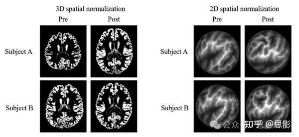 使用VBM和SBM在皮质形态分析中的优势 - 知乎
