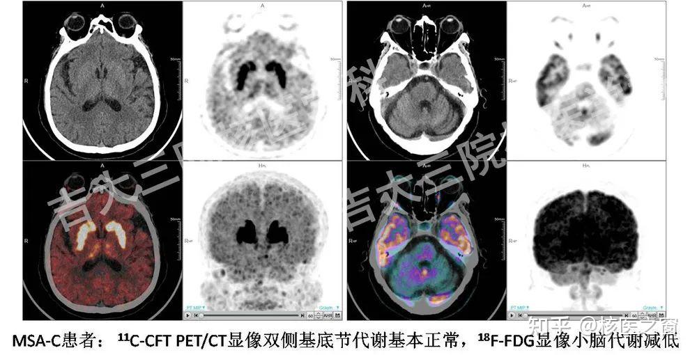 【干货】核医学科一出手，帕金森病抖一抖 - 知乎