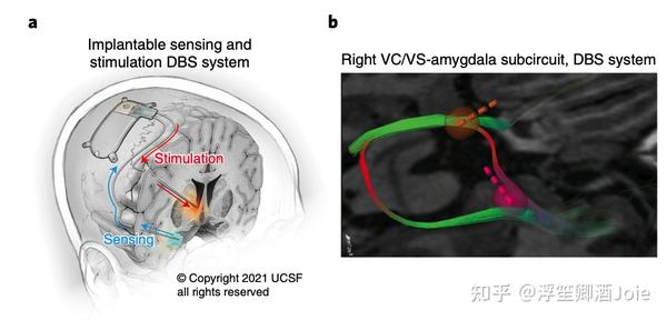 【THERAPY】Closed-loop neuromodulation in an individual with treatment ...