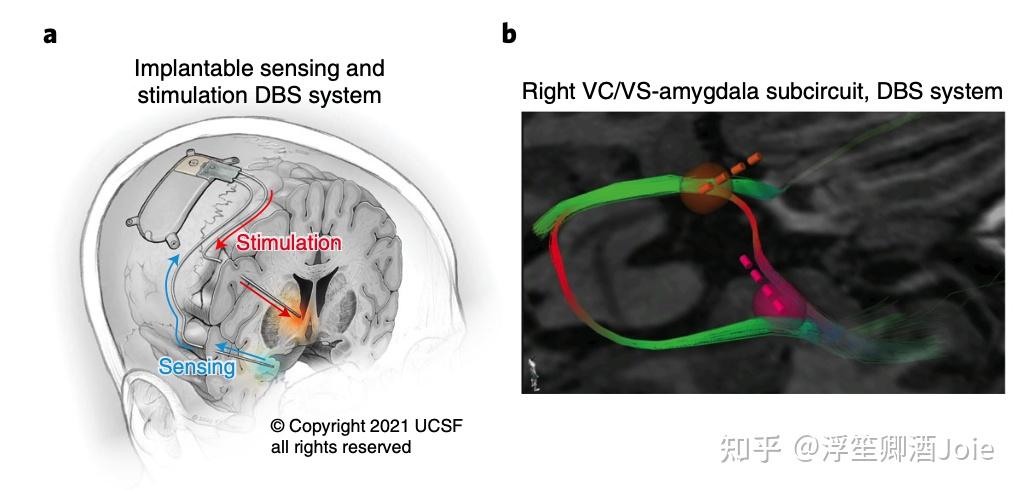 【THERAPY】Closed-loop neuromodulation in an individual with treatment ...