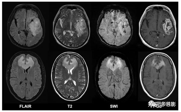 磁敏感加权成像（SWI)：技术要点和临床神经学应用 - 知乎