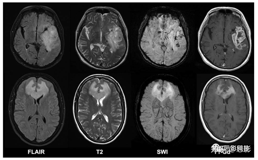 磁敏感加权成像（SWI)：技术要点和临床神经学应用 - 知乎