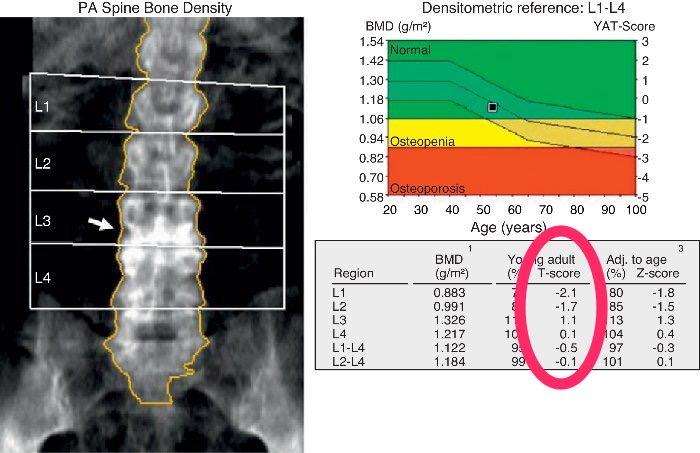 是时候说一下「骨密度检查」（DXA）了 - 知乎
