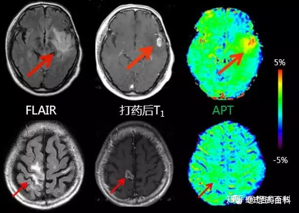 “穷人”的分子影像学——APT - 知乎