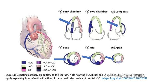 急性瓣膜病—严重的主动脉、二尖瓣返流及分流 - 知乎
