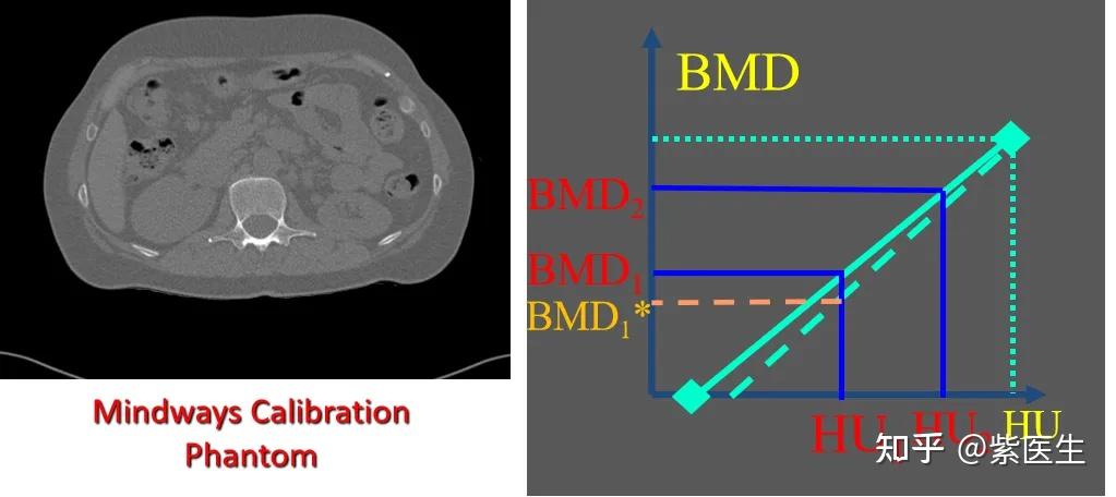 定量CT（QCT）是什么？临床应用有哪些？ - 知乎