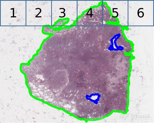 CLAM: A Deep-Learning-based Pipeline for Data Efficient and Weakly Supervised Whole-Slide-level ...