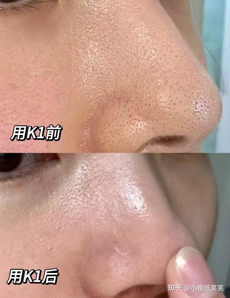 男生黑头多,有没有能去黑头的洗面奶? 知乎