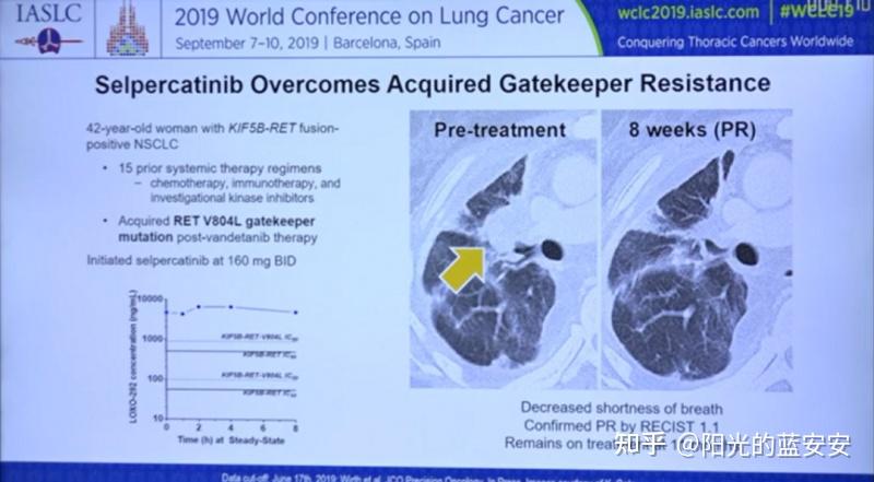 肺癌新药Retevmo治疗案例介绍：4周后肿瘤显著缩小 - 知乎