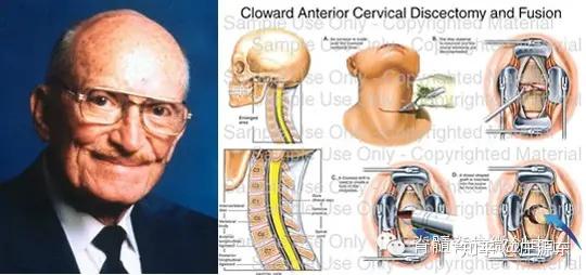 Ralph Bingham Cloward-颈椎前路椎间盘切除椎间融合术的发明者 - 知乎