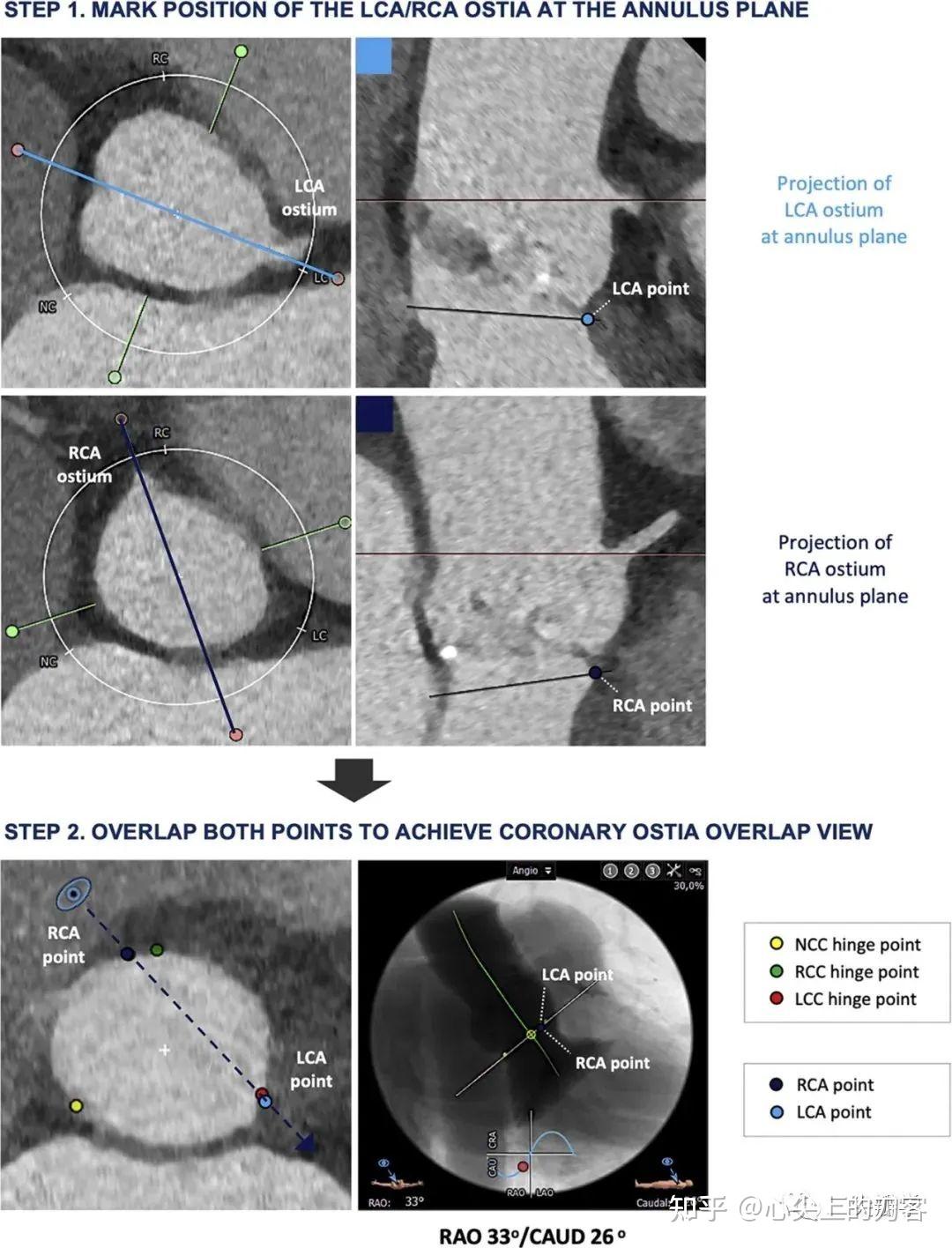 连合对齐（Commissural Alignment）：原理、定义、技术和结果（下） - 知乎