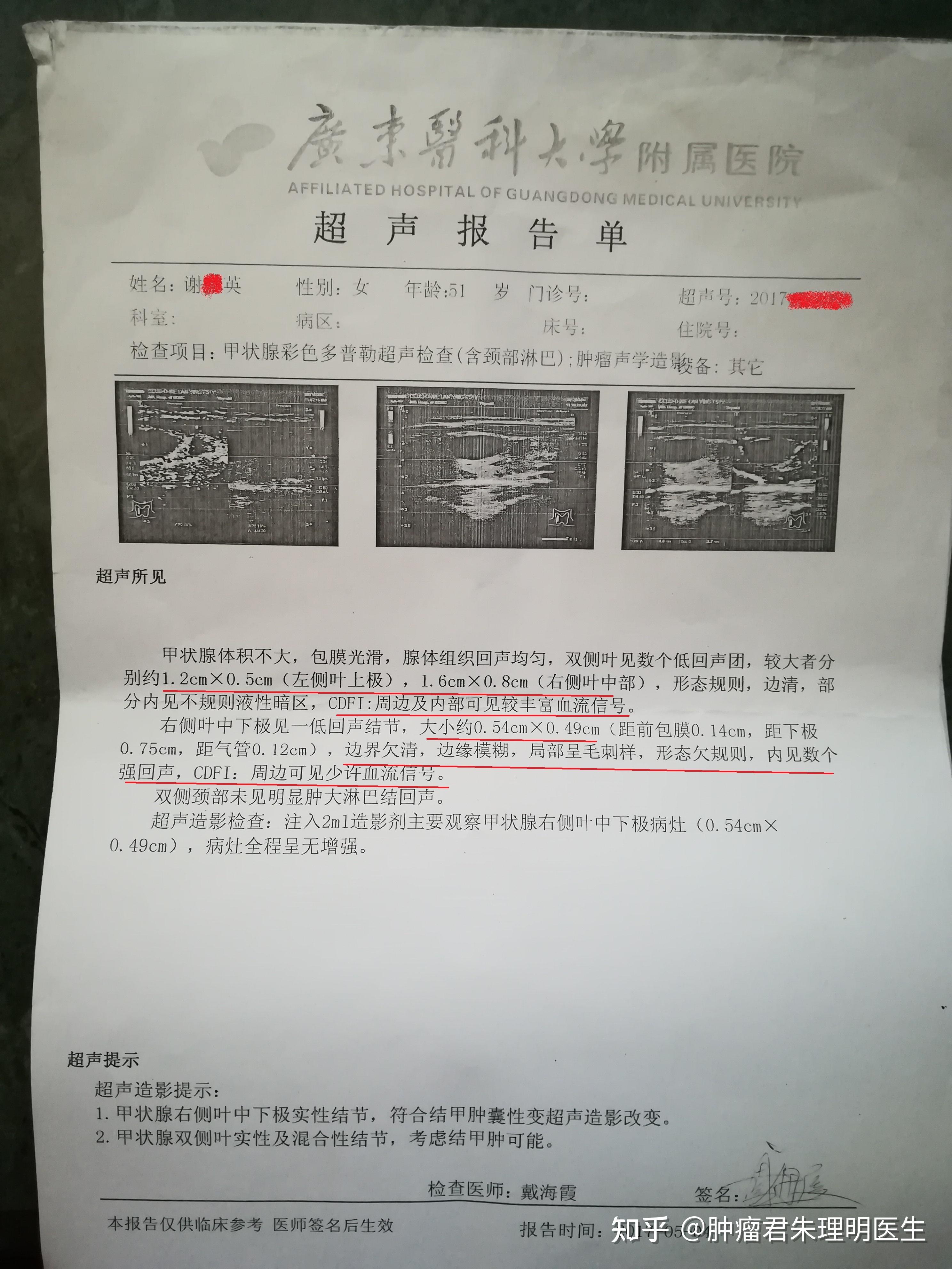 乳腺结节 Bi Rads 4a类 知乎