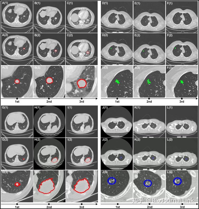 生物图像 | Cell.Rep.Med | 基于纵向CT图像的人工智能聊天机器人对肺结节的评估 - 知乎