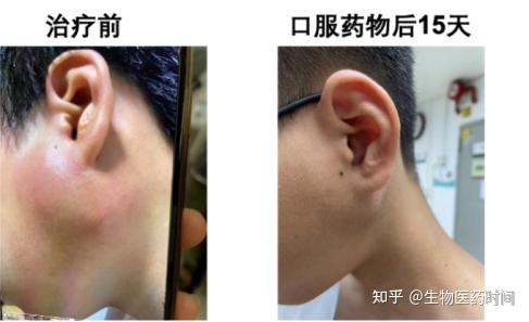 新一代NTRK抑制剂ICP-723治疗实体瘤临床研究病案分享 - 知乎