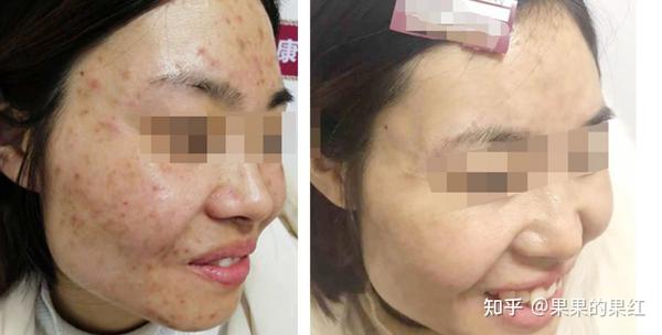 痘痘反反复复怎么办? 知乎