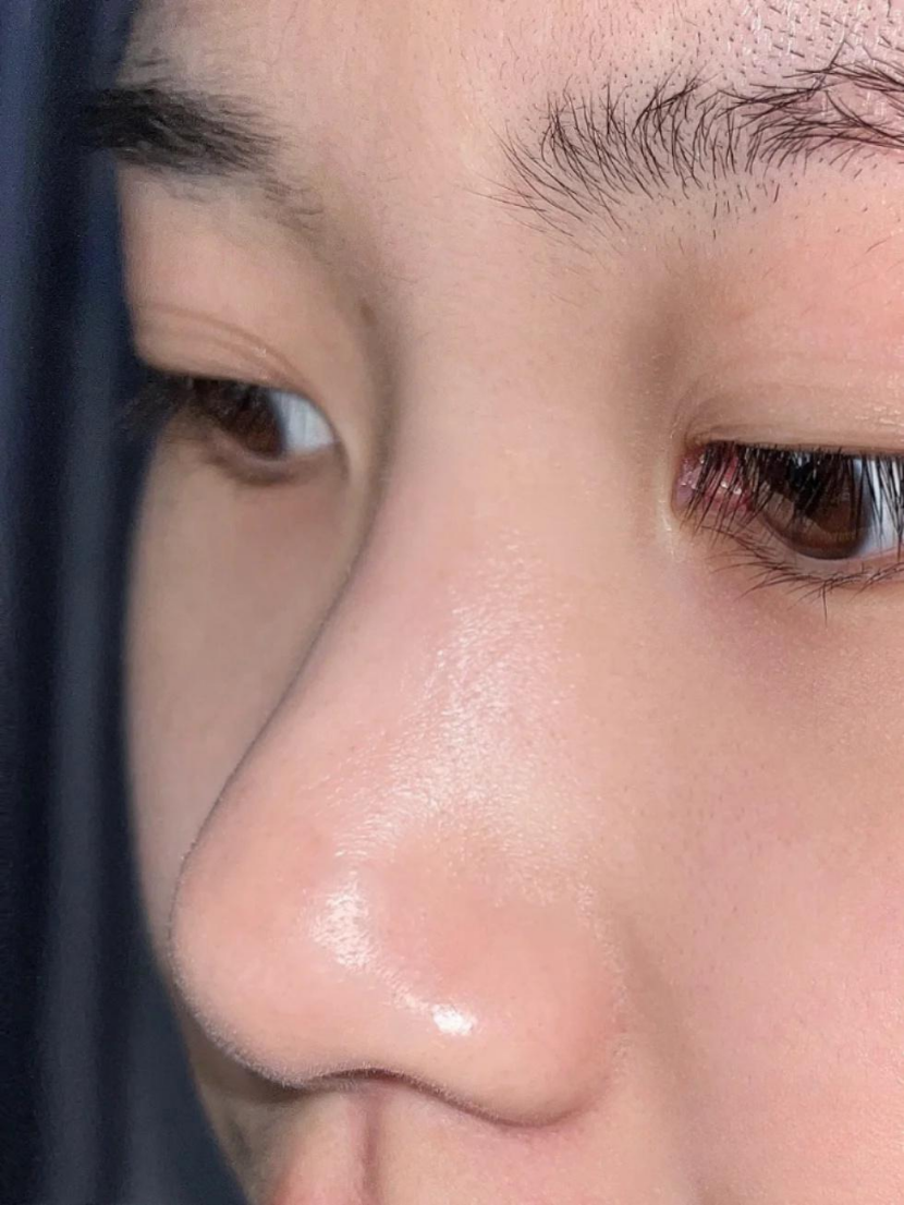 黑头多的我密集恐惧症都要犯了,最后还是老妈带我去了趟皮肤科才整好脸上的黑头和大毛孔!学生党别再使用野鸡方子了,速来白嫖!! 知乎