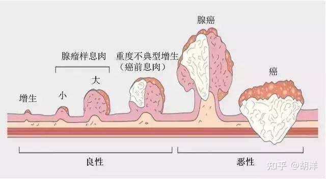 有可能转变成癌的病变叫癌前病变,从头到脚的癌前病变都列在这了 知乎