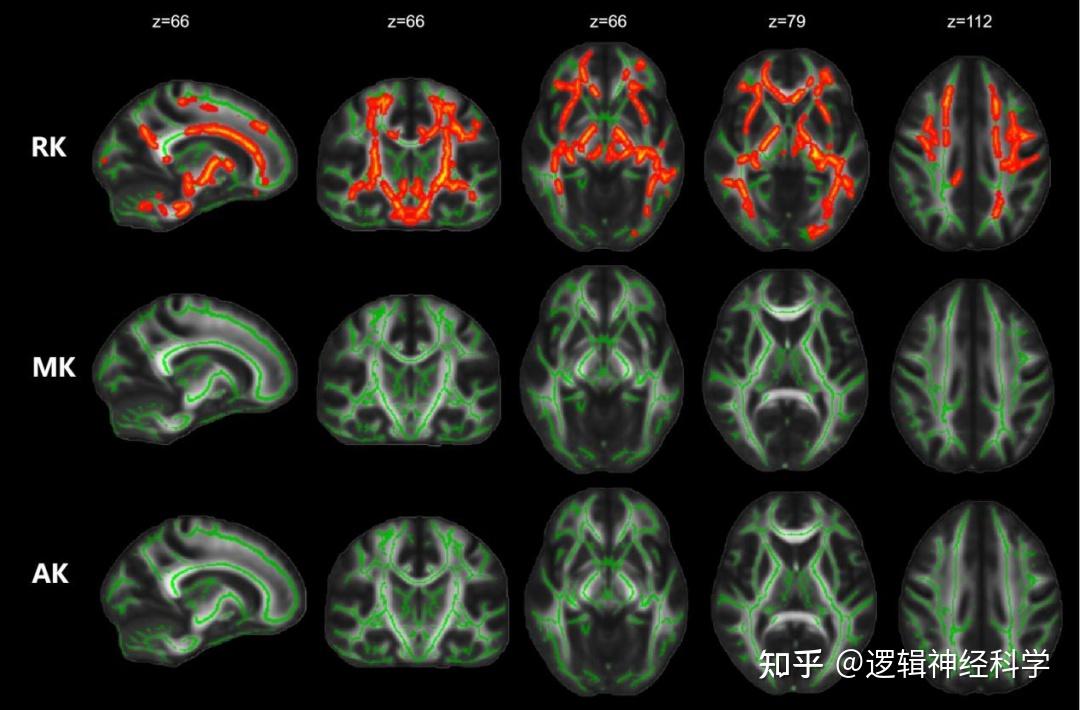 J Neurol︱特发性震颤患者脑微结构改变及其与临床特征的相关性：一项弥散峰度成像研究 - 知乎