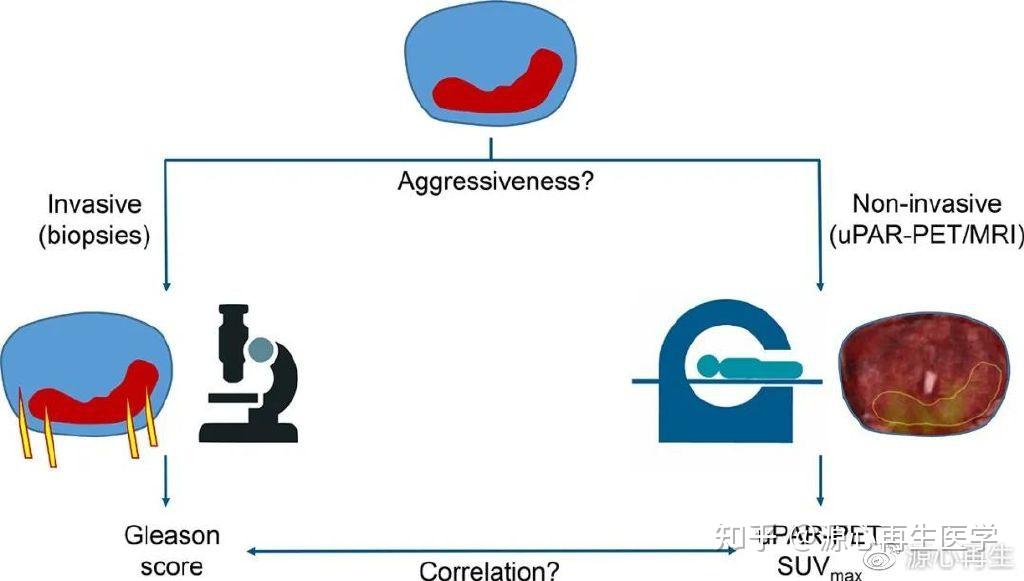JNM丨精准治疗：靶向uPAR 68Ga-NOTA-AE105 PET/MRI技术助力前列腺癌诊断和治疗 - 知乎