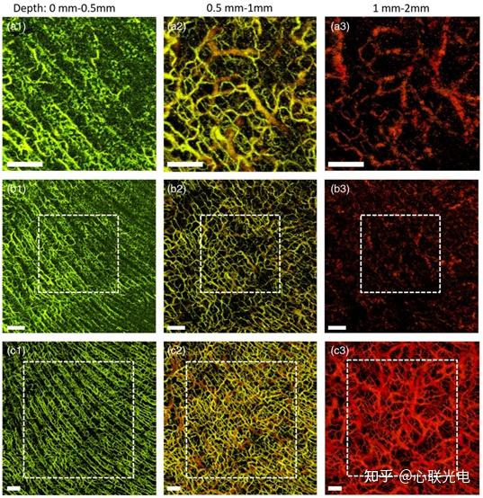 J Biomed Opt：长距离swept-source OCTA在皮肤微循环成像方面的优越性 - 知乎
