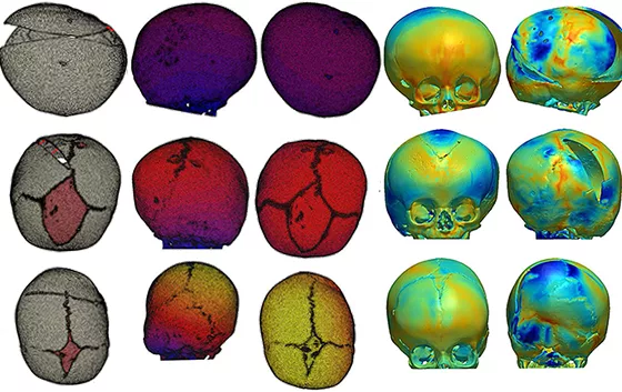 【Simpleware】患者颅缝早闭矫正的计算模拟 - 知乎