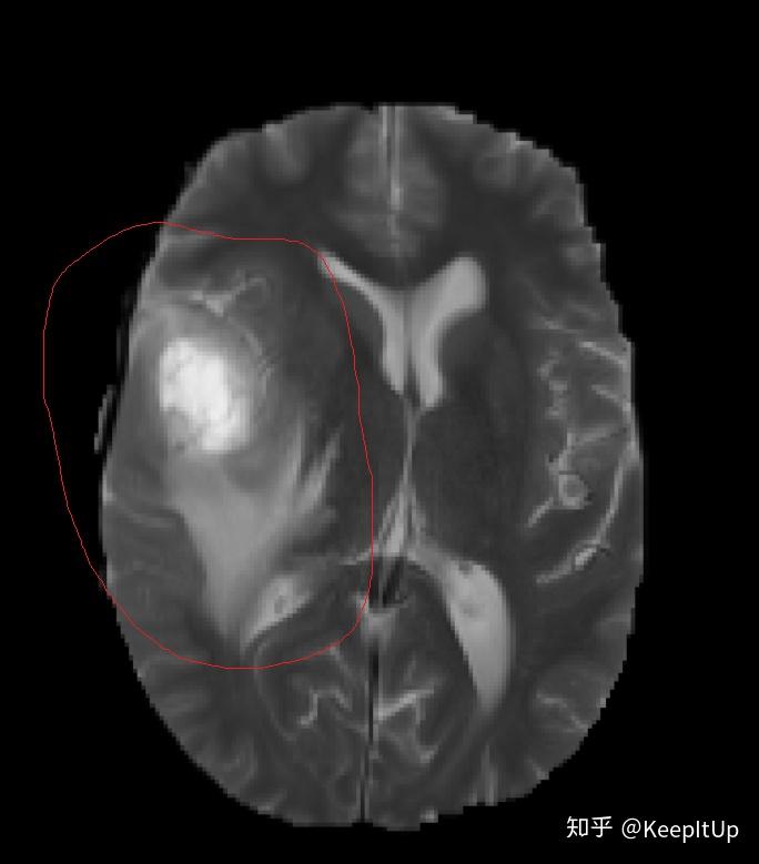 医学影像分割入门、MRI、t1、t2等序列概念 - 知乎