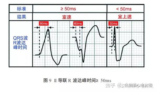 宽QRS波心动过速的鉴别诊断 - 知乎