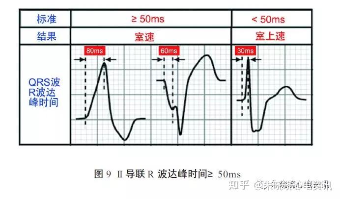 宽QRS波心动过速的鉴别诊断 - 知乎