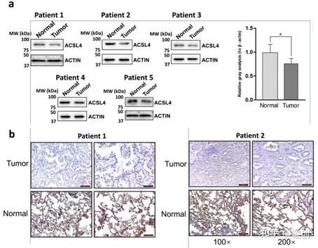 棕榈酸下调ACSL4抑制肺腺癌细胞的铁死亡加重疾病进展的经验分享（棕榈酸水溶液、棕榈酸BSA溶液） - 知乎