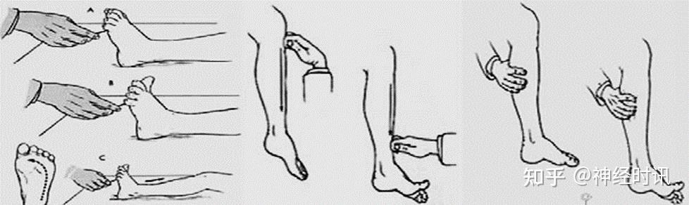 神经系统检查 — 感觉，运动，神经反射检查 - 知乎