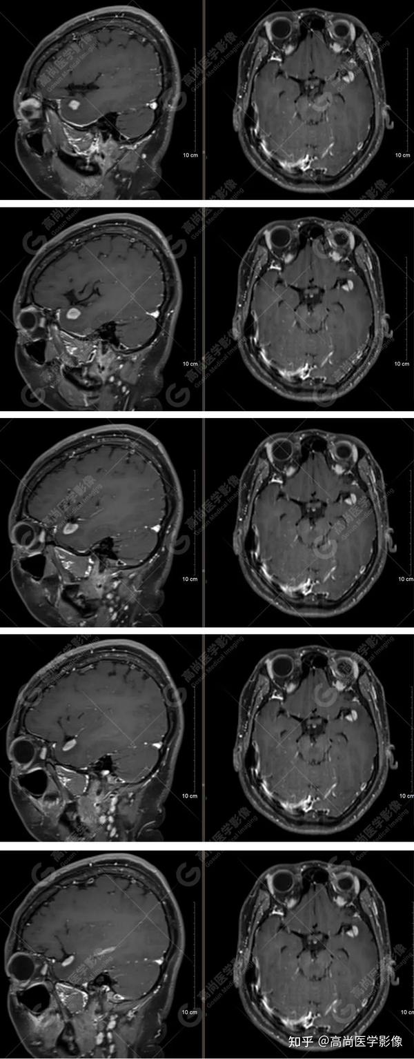 少见类型脑膜瘤回顾分析【高尚医学影像】 - 知乎