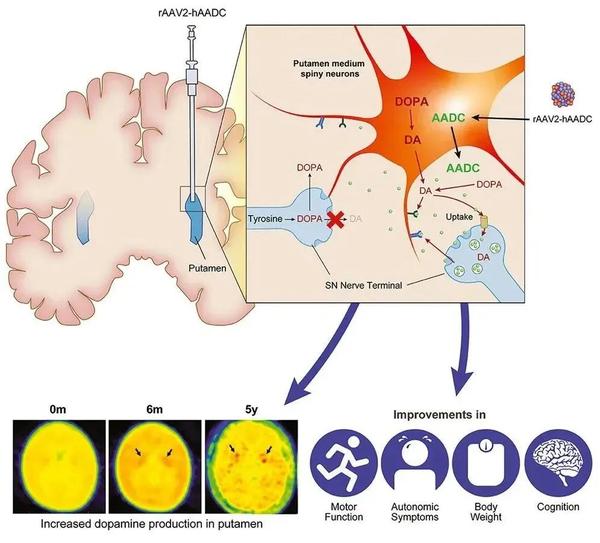 首款直接入脑的AAV基因治疗在欧盟获批上市 - 知乎