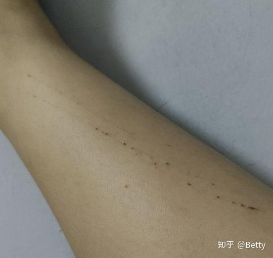 早上醒来身上出现划痕 伤痕 知乎